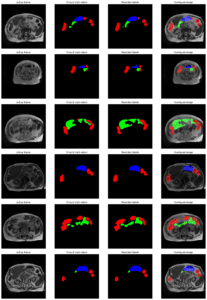 Medical Image Segmentation Using 🤗 HuggingFace & PyTorch