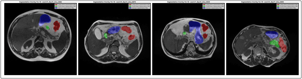 Medical Image Segmentation Using 🤗 HuggingFace & PyTorch Medical Image Segmentation Using 🤗 HuggingFace & PyTorch