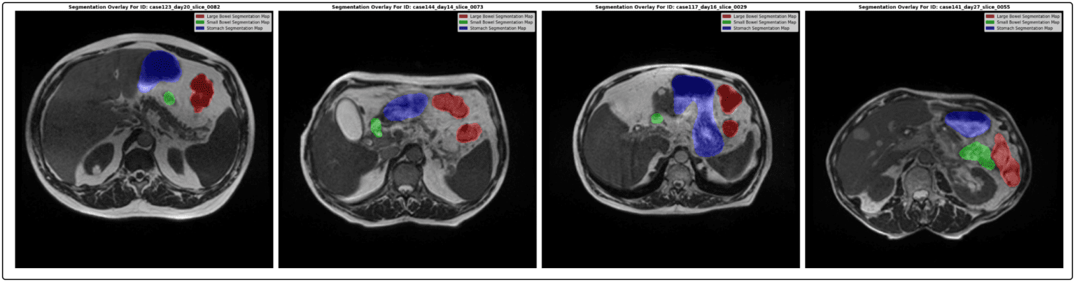 Medical Image Segmentation Using 🤗 HuggingFace & PyTorch