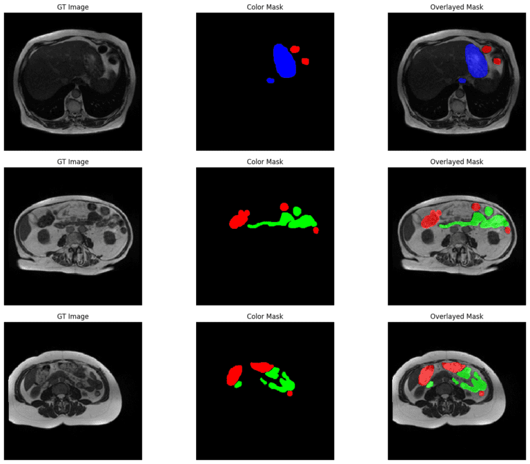 Medical Image Segmentation Using 🤗 HuggingFace & PyTorch Medical Image Segmentation Using 🤗 HuggingFace & PyTorch
